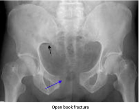 Unstable Pelvic Ring Fractures — Maimonides Emergency Medicine Residency