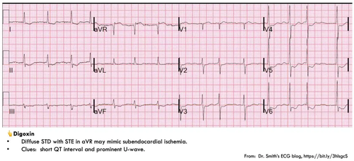 POTD: Digoxin toxicity — Maimonides Emergency Medicine Residency
