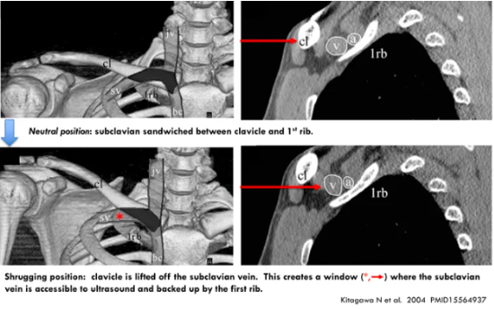 US Guided Subclavian Lines — Maimonides Emergency Medicine Residency