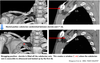 US Guided Subclavian Lines — Maimonides Emergency Medicine Residency