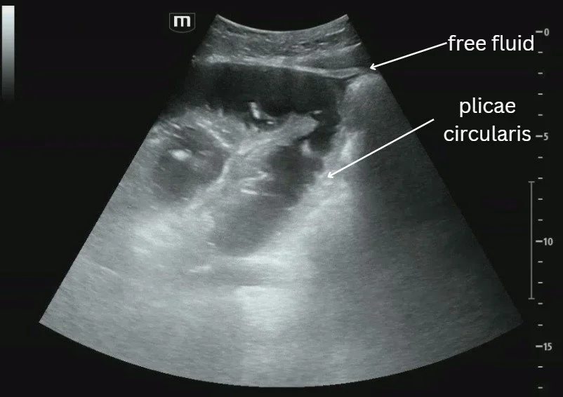 VOTW: Small Bowel Obstruction — Maimonides Emergency Medicine Residency