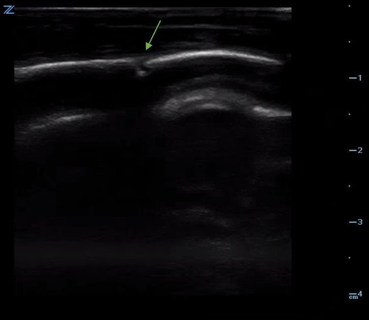 VOTW: Pediatric Skull Fracture — Maimonides Emergency Medicine Residency