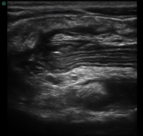 VOTW: Intussusception — Maimonides Emergency Medicine Residency