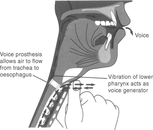 POTD: Tracheostomy and Laryngectomy Emergencies — Maimonides Emergency ...