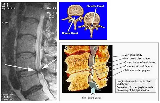 Lateral Recess Lumbar