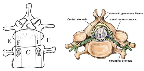 Lateral Recess Lumbar