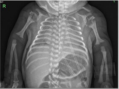 Neonatal rhizomelic chondrodysplasia punctata type 2 caused by a novel ...