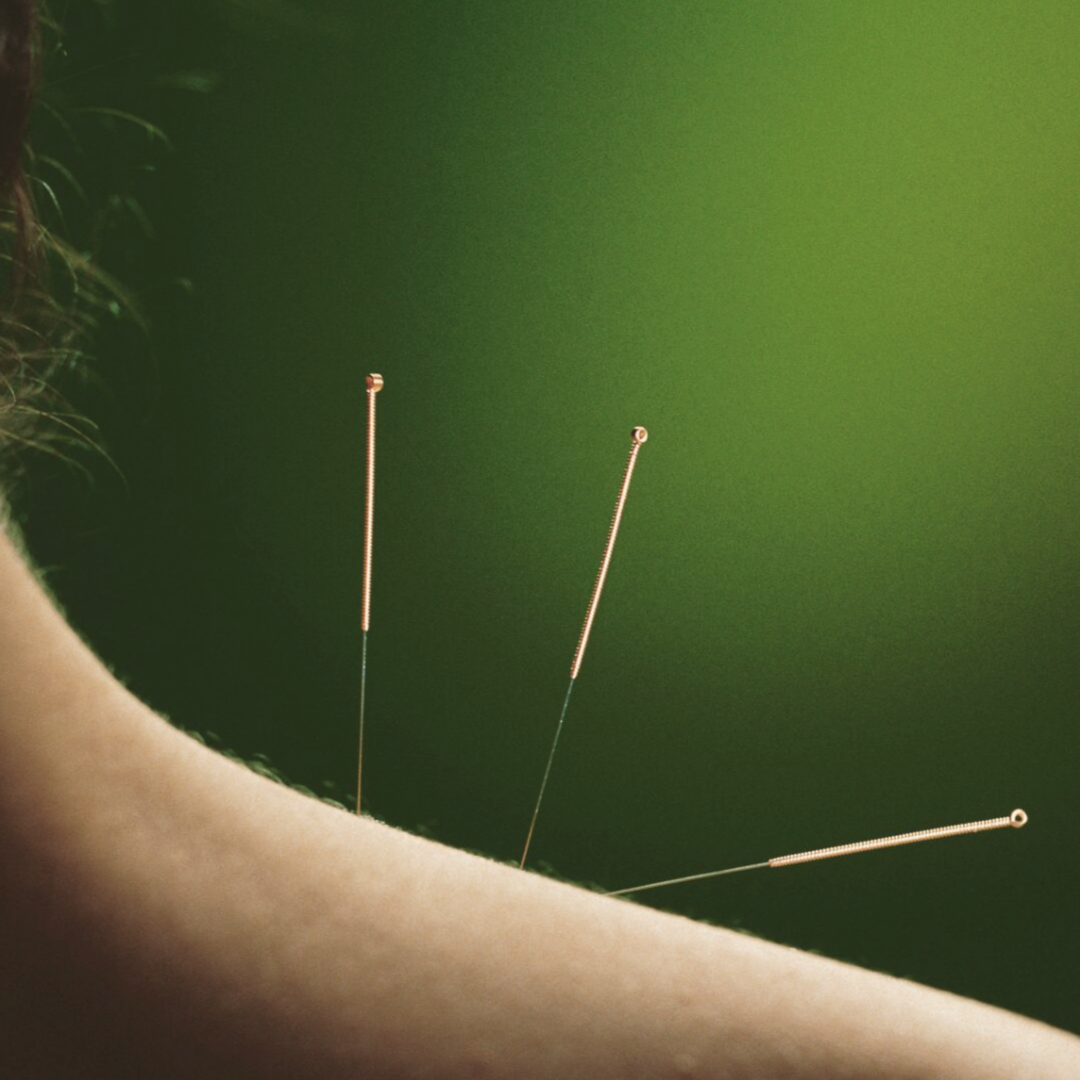 Ayurvedic Acupuncture — GIAM