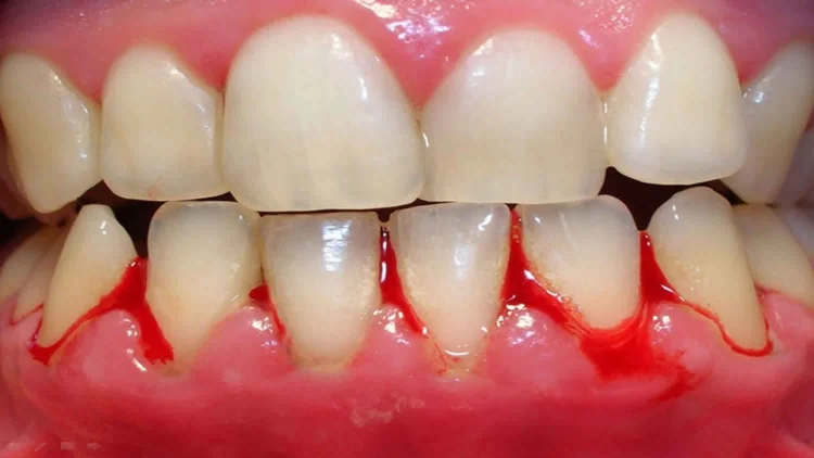¿Qué es la gingivitis? — Odontologic