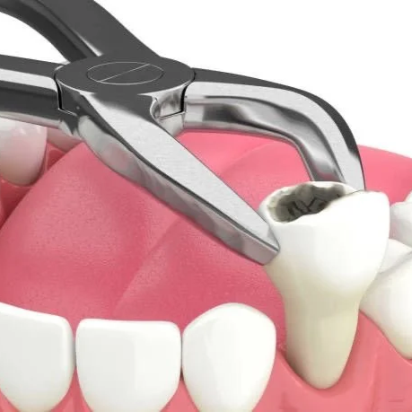 Endodoncia o Exodoncia: ¿Cuál Necesito? — Odontologic