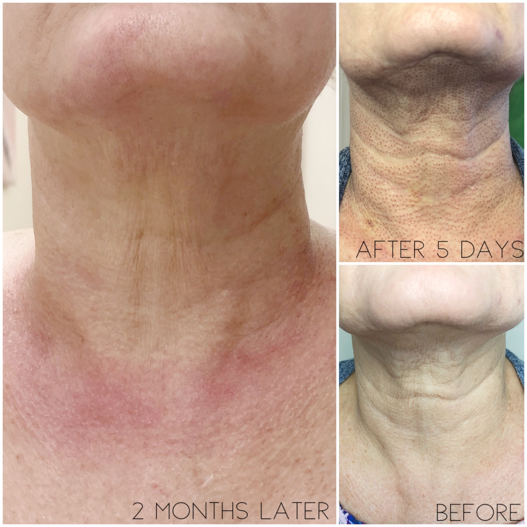 Fibroblast Skin Tightening — AskCares