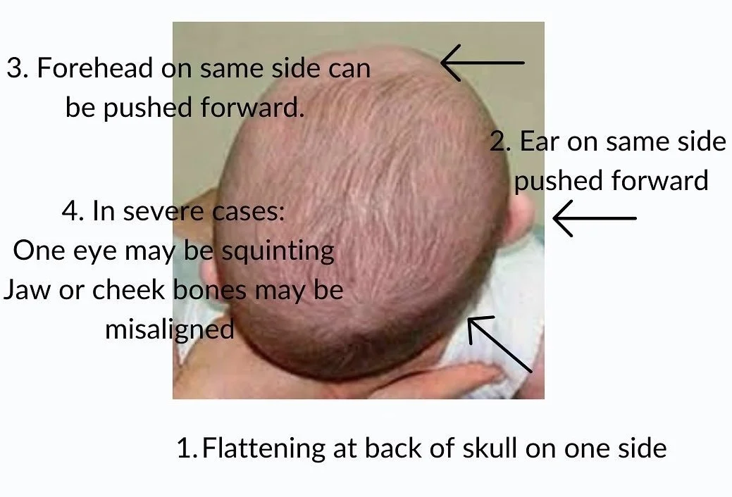 Plagiocephaly Positional Plagiocephaly Flat Head 58 OFF Plagiocephaly Positional Plagiocephaly Flat Head 58 OFF