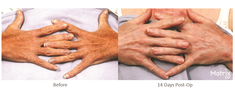 Hand Rejuvenation — Dr. Darab Hormozi - Oculofacial Surgeon