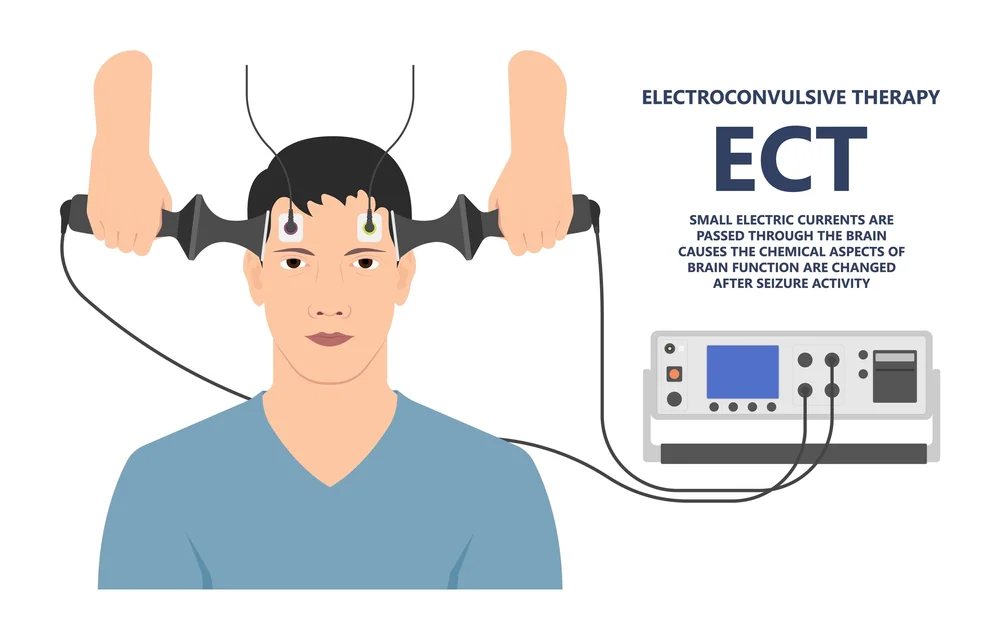 Revisiting Electroconvulsive Therapy - Part 1 — Gordon Corsetti Mental ...