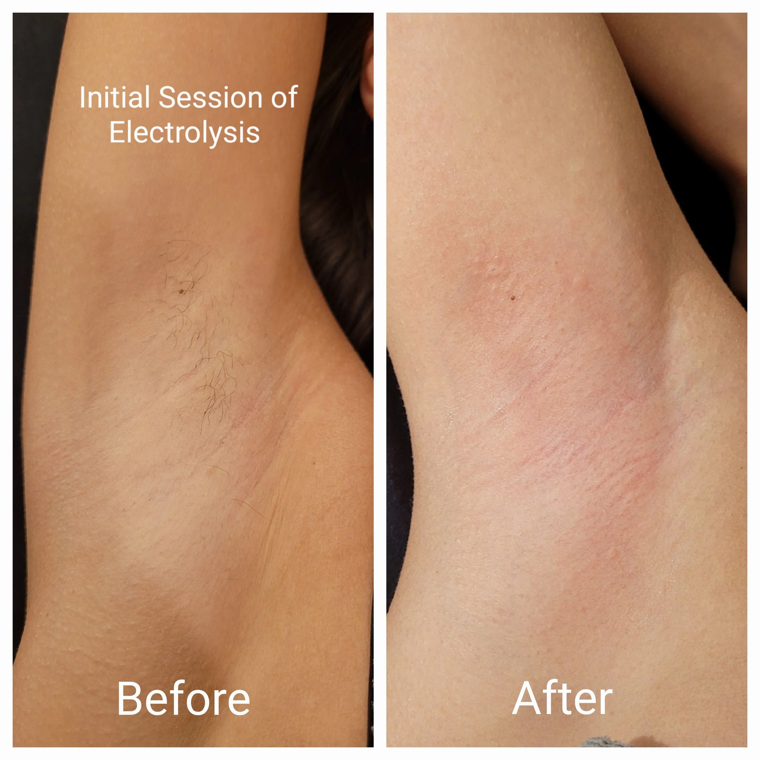 Photos — Bonney Lake Electrology & Wax