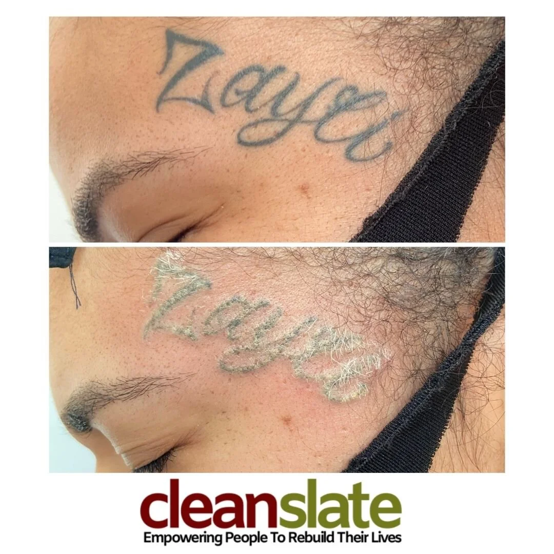 Tattoos - Before & After — CLEANSLATE LA