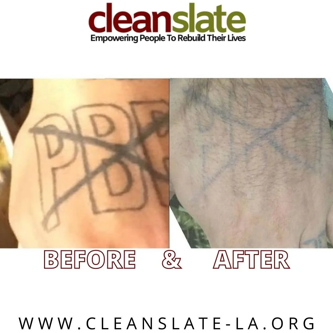 Tattoos - Before & After — CLEANSLATE LA