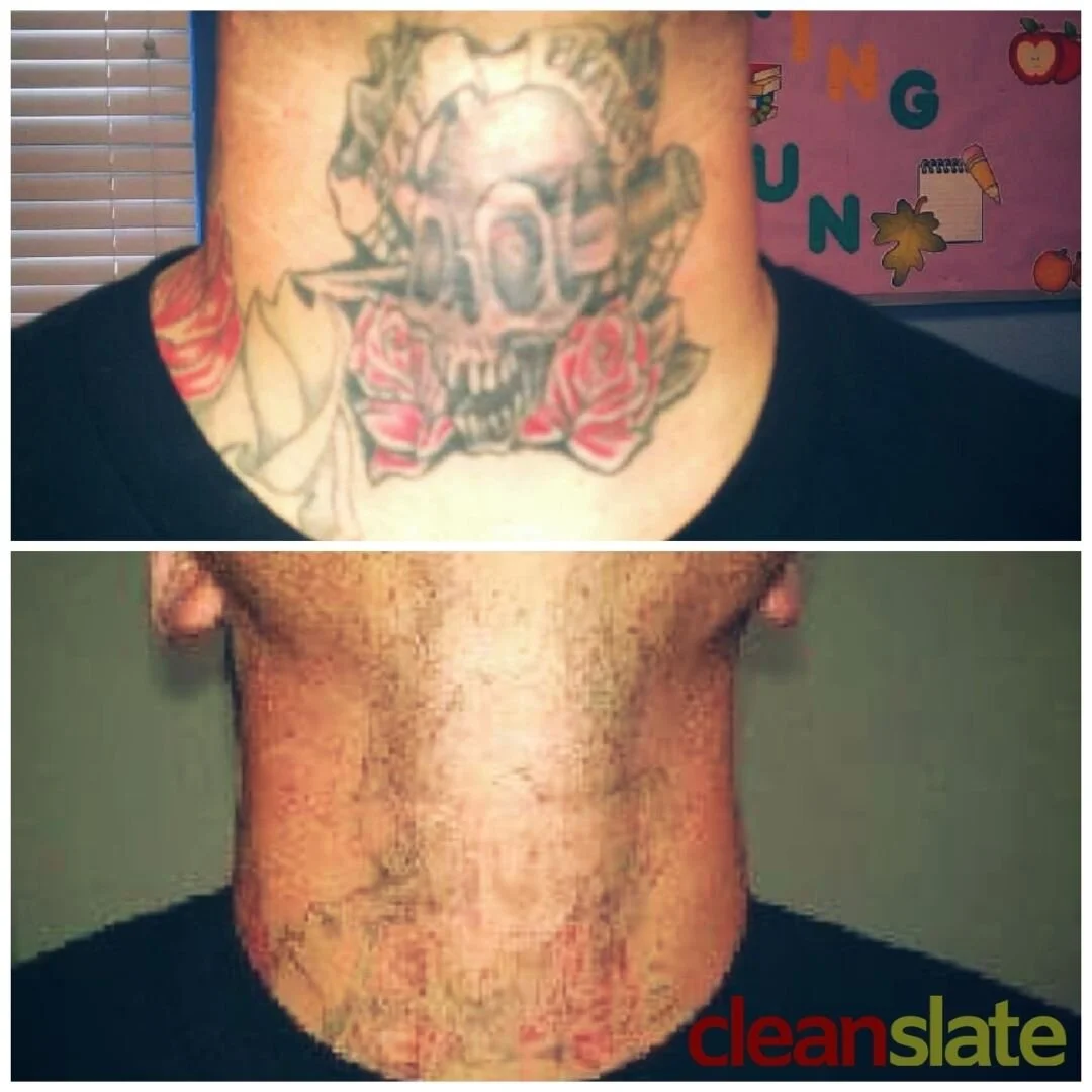 Tattoos - Before & After — CLEANSLATE LA
