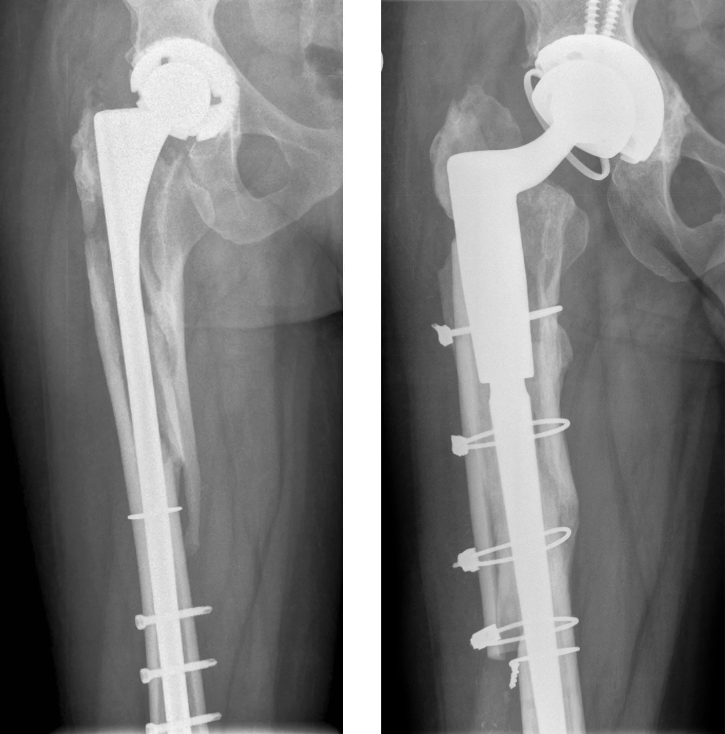 Revision Total Hip Replacement Constant Busch Revision Total Hip Replacement Constant Busch