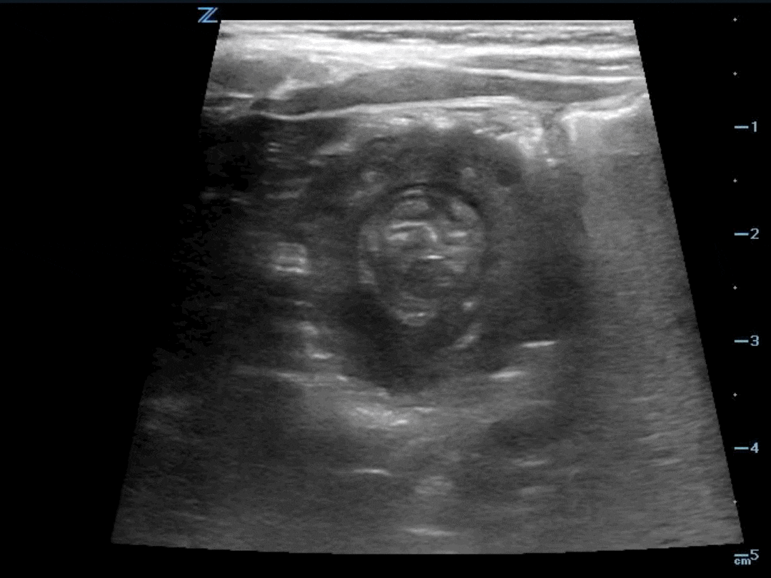 COTW August 1st A 3 year Old Male With Intermittent Abdominal Pain For cotw-august-1st-a-3-year-old-male-with-intermittent-abdominal-pain-for