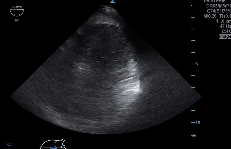 Ventricular Fibrillation Gif