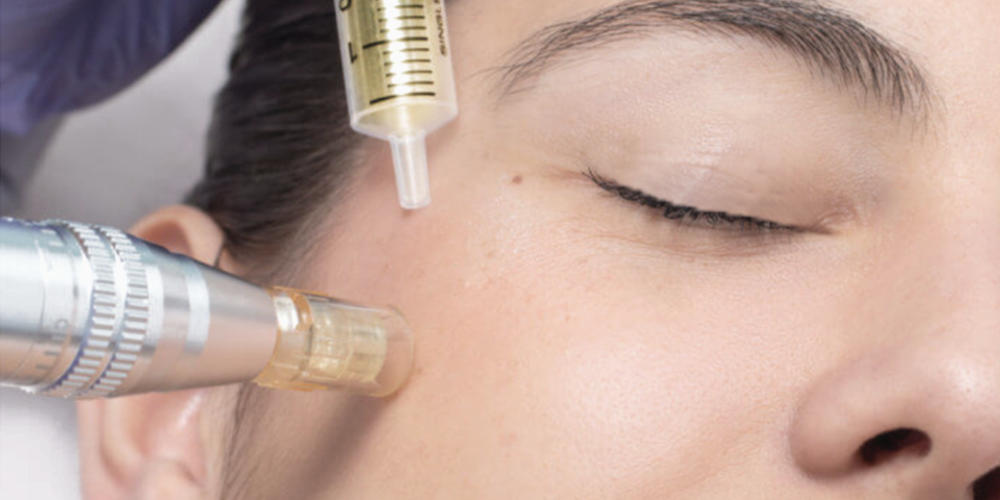 Fusion Fractional Mesotherapy Perth