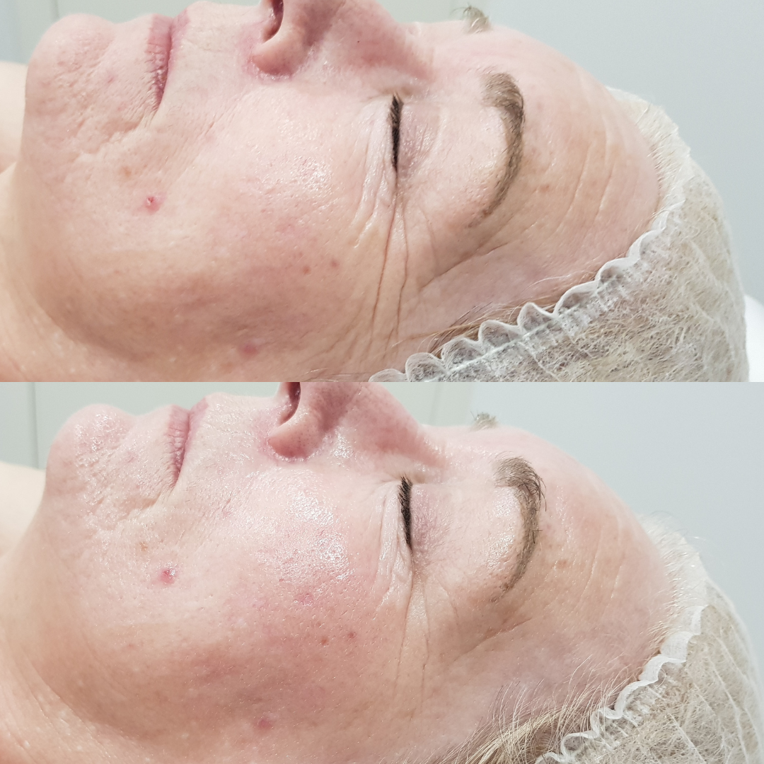 RF Skin Tightening | TriPollar® RF (Radio Frequency)