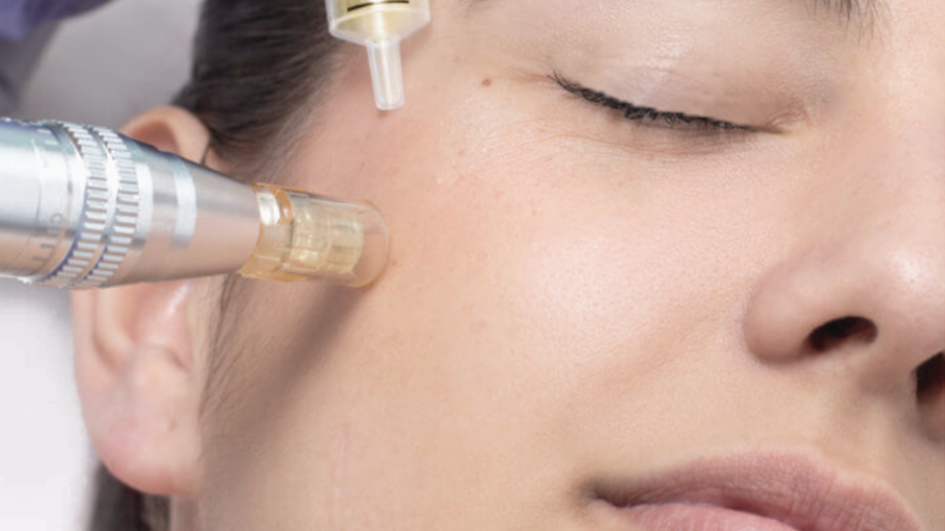 Fusion Fractional Mesotherapy Perth