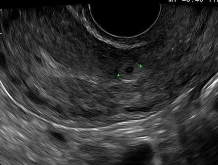 Cesarean Scar Ectopic Pregnancy — CREOGS Over Coffee
