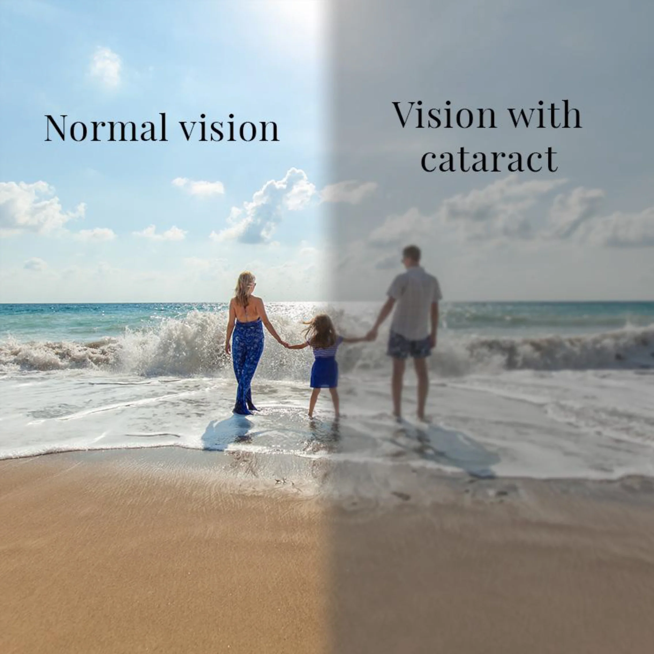 Cataract Vision Simulation