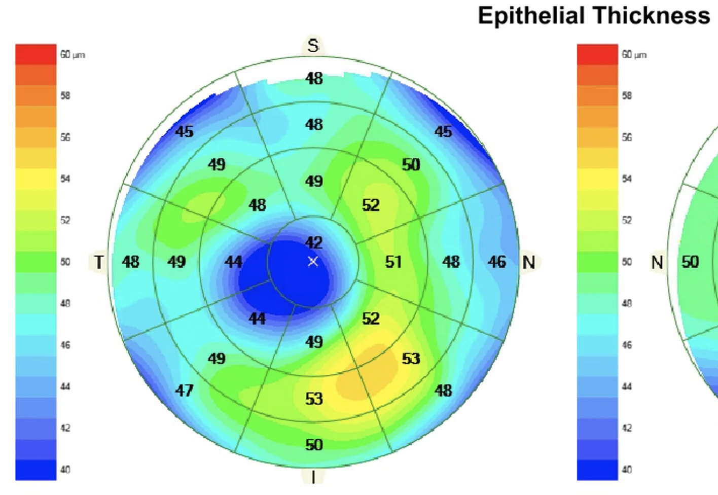 Advanced Keratoconus Treatment Brisbane — Dr David Gunn · Brisbane ...