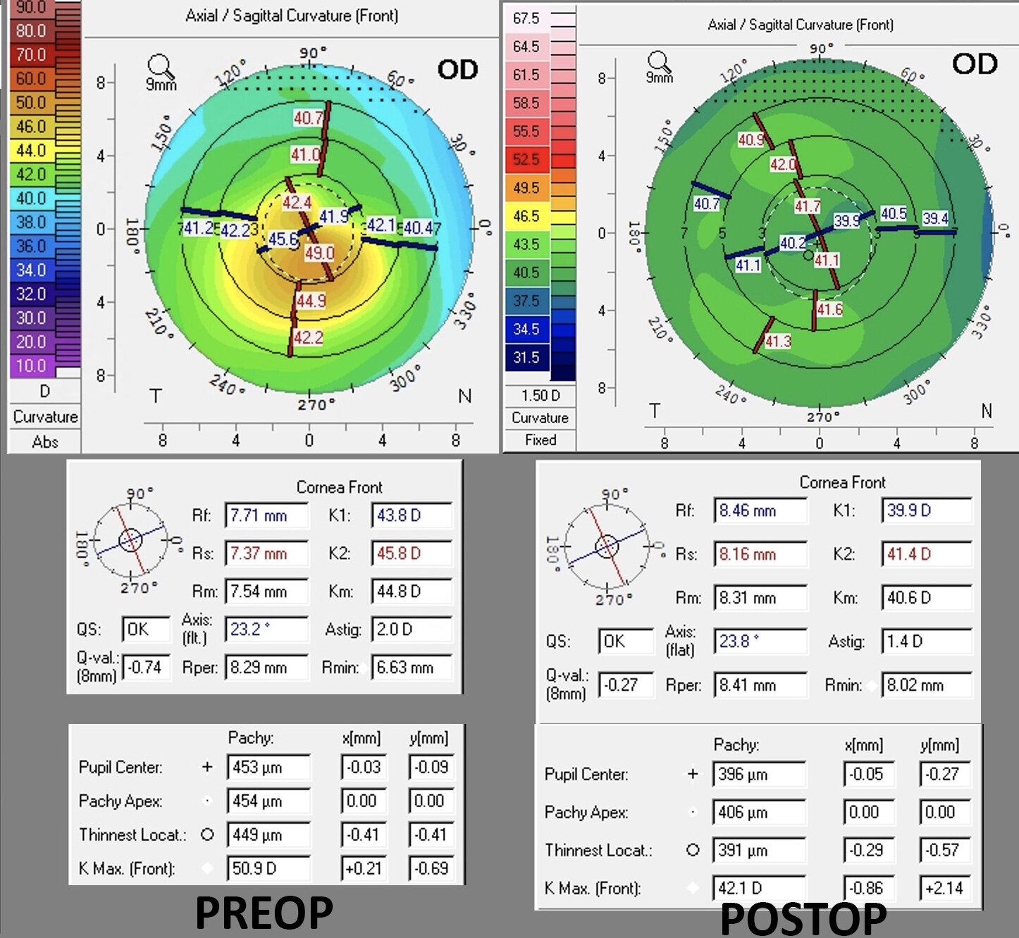Advanced Keratoconus Treatment Brisbane — Dr David Gunn · Brisbane ...