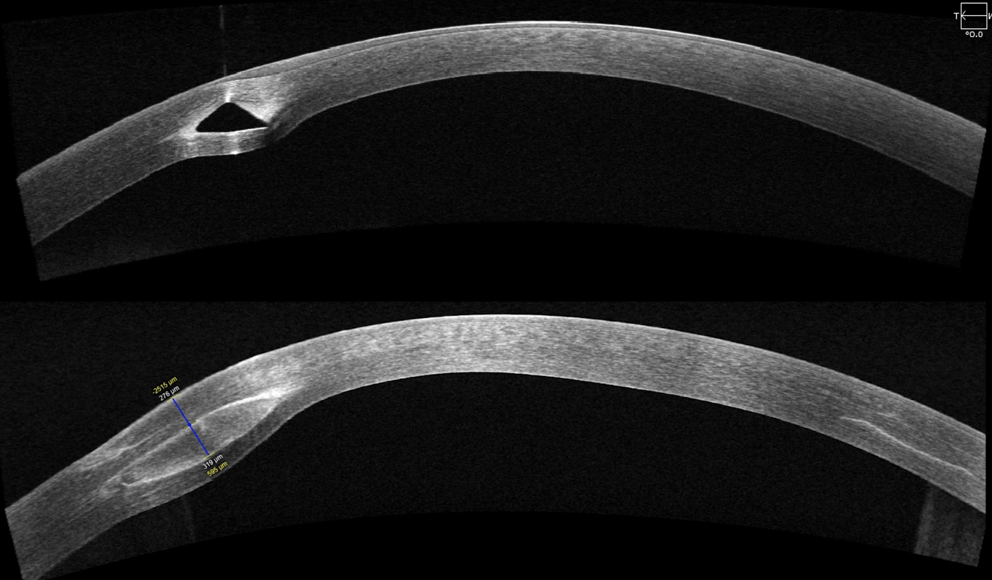 New Keratoconus Treatment Australia: CAIRS - Corneal Allogenic ...