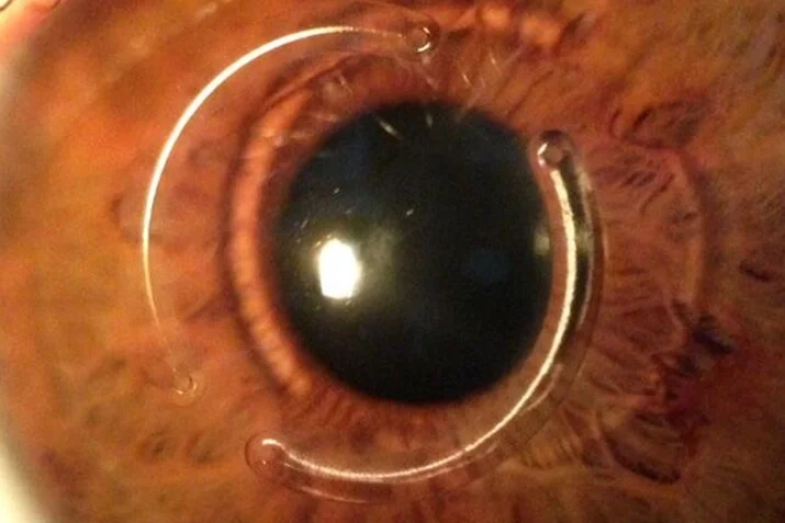 New Keratoconus Treatment Australia: CAIRS - Corneal Allogenic ...