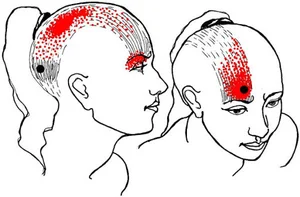 Cervicogenic Headache Patterns — Restore Physical Therapy