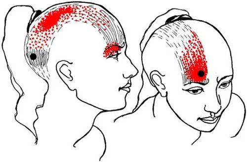 Cervicogenic Headache Patterns — Restore Physical Therapy