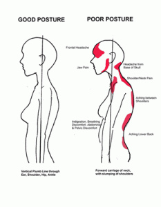 Cervicogenic Headache Patterns — Restore Physical Therapy