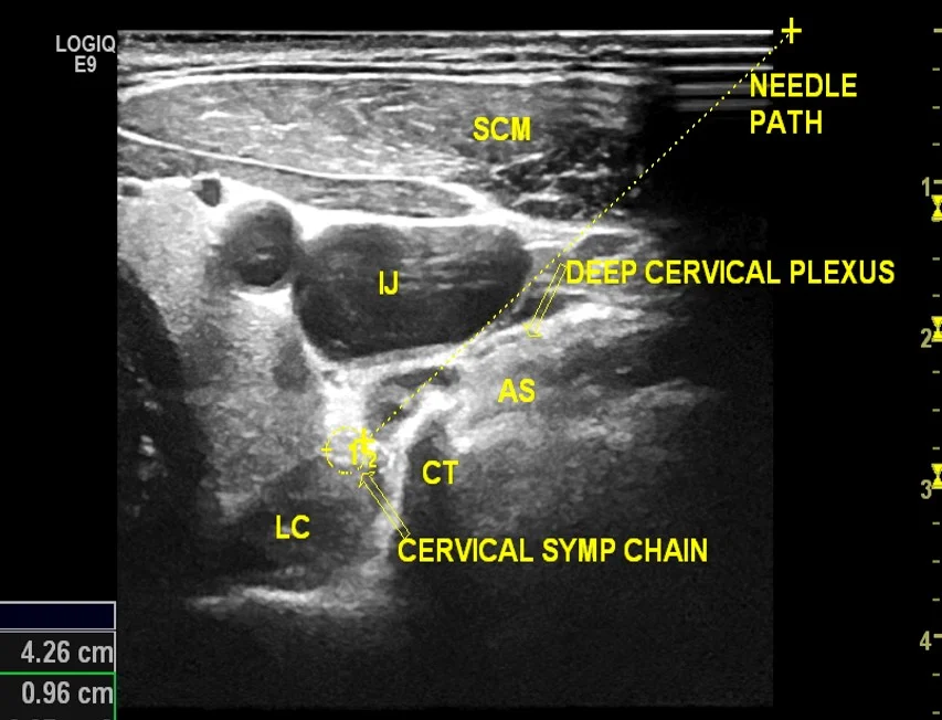 Stellate Ganglion Block