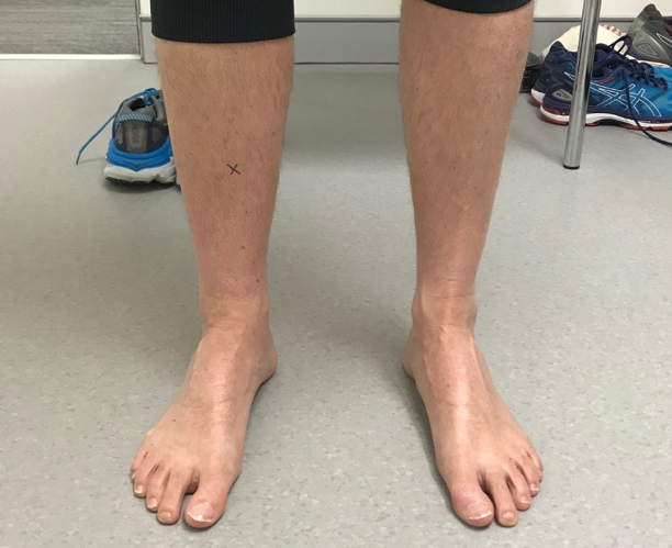 Shin Splints - Leg Pain When Running - Podiatrist Treatment