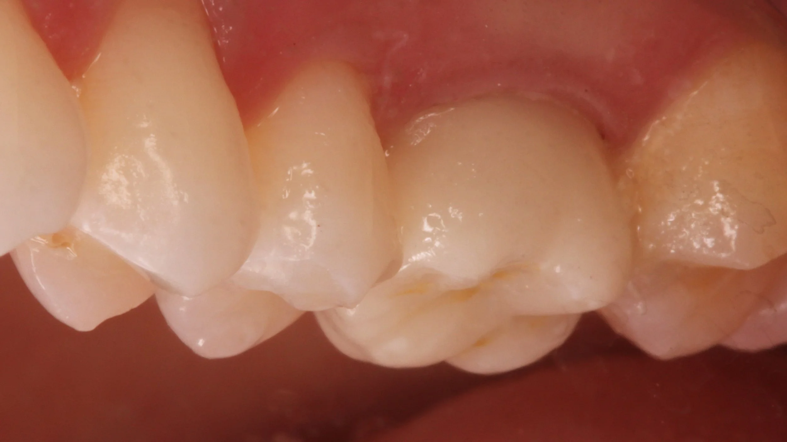 CEREC Crowns | Point Loma | San Diego — Harbor Dental
