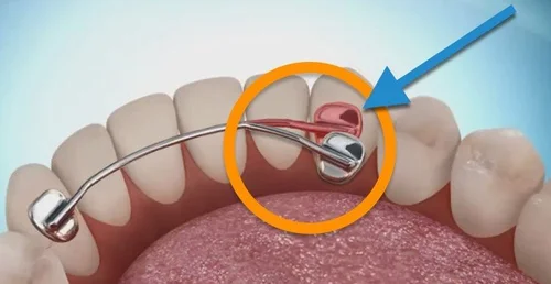 [Updated] Dental Code for Rebonding Lingual Retainer — Harbor Dental ...