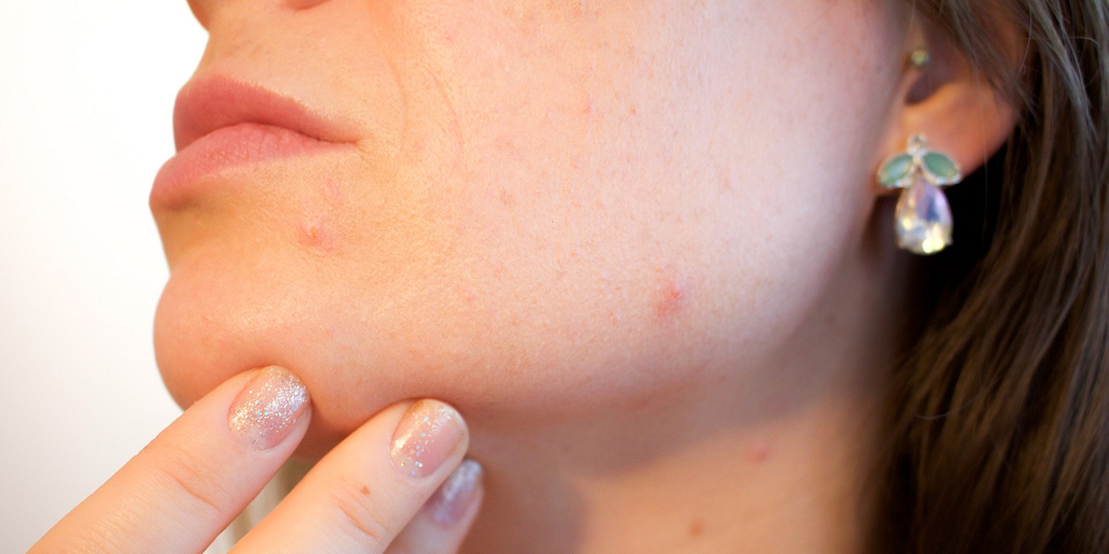 Why am I breaking out? 6 reasons why you’re getting pimples, despite ...