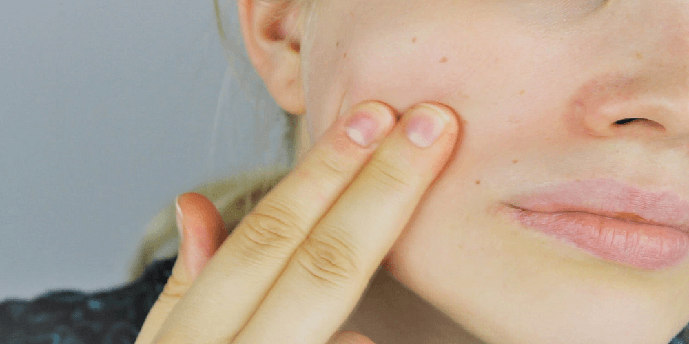 Why am I breaking out? 6 reasons why you’re getting pimples, despite ...