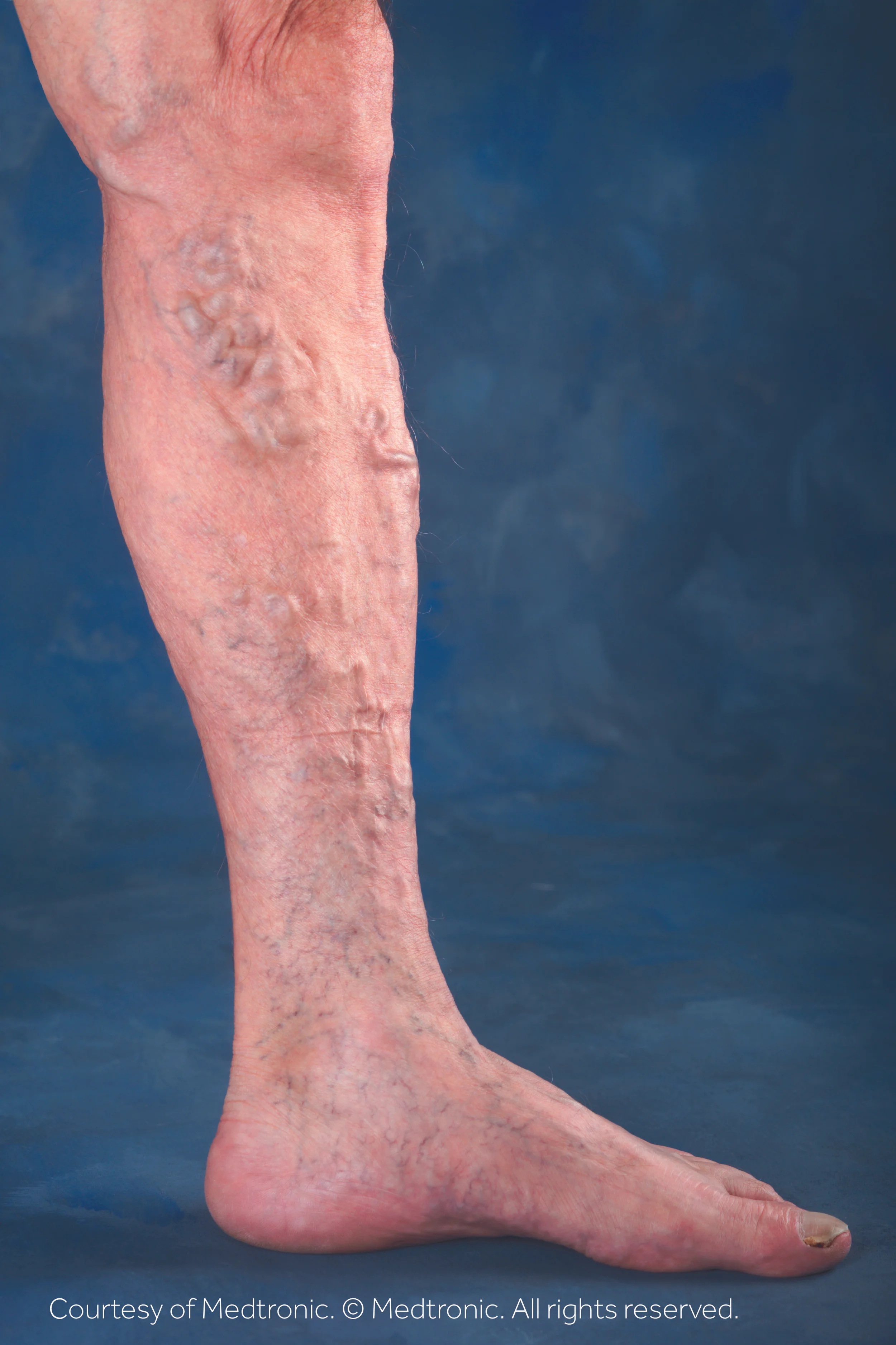 Frequently Asked Questions About Varicose & Spider Veins