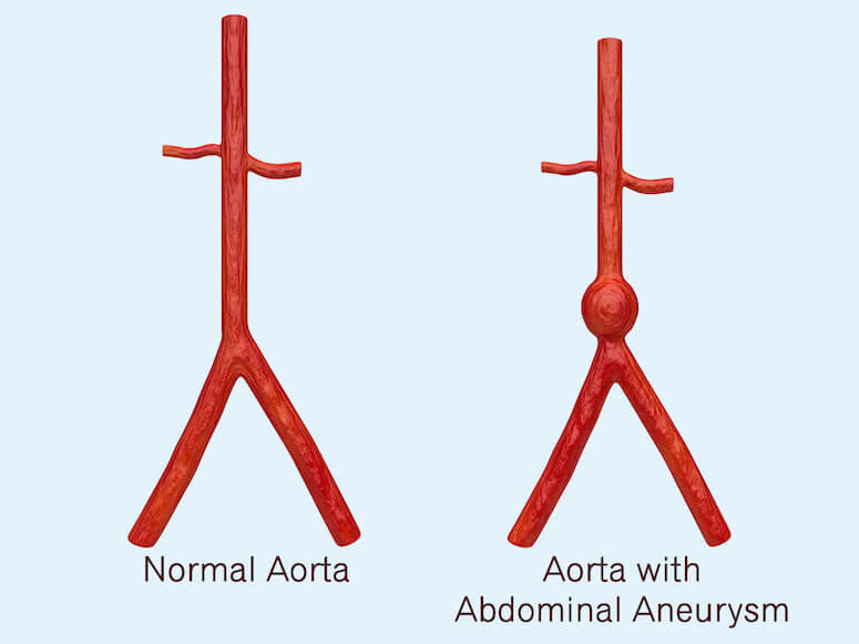 Understanding The Basics Of Aneurysms Vascular Surgery Specialist 