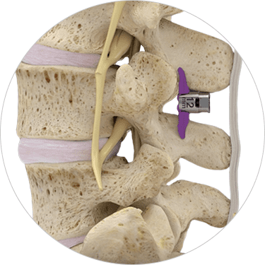 Vertiflex Superion Specialist | Vertiflex Procedure | Spinal Stenosis ...