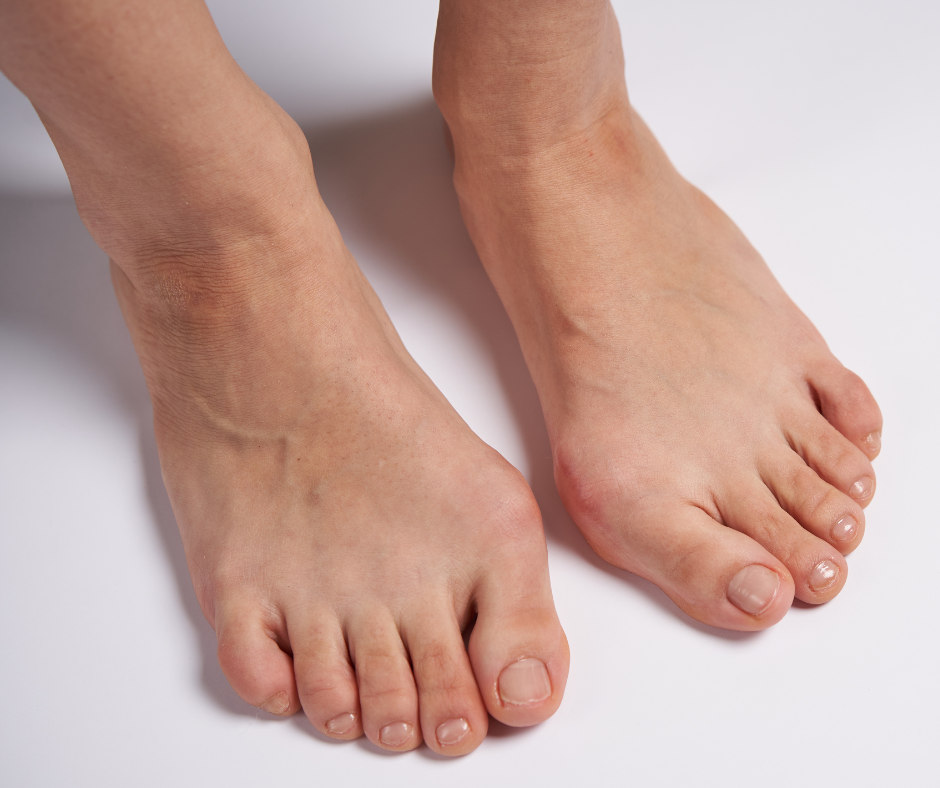 The Downstream Effects of Congenital Foot Conditions — PodiatryCare, P ...
