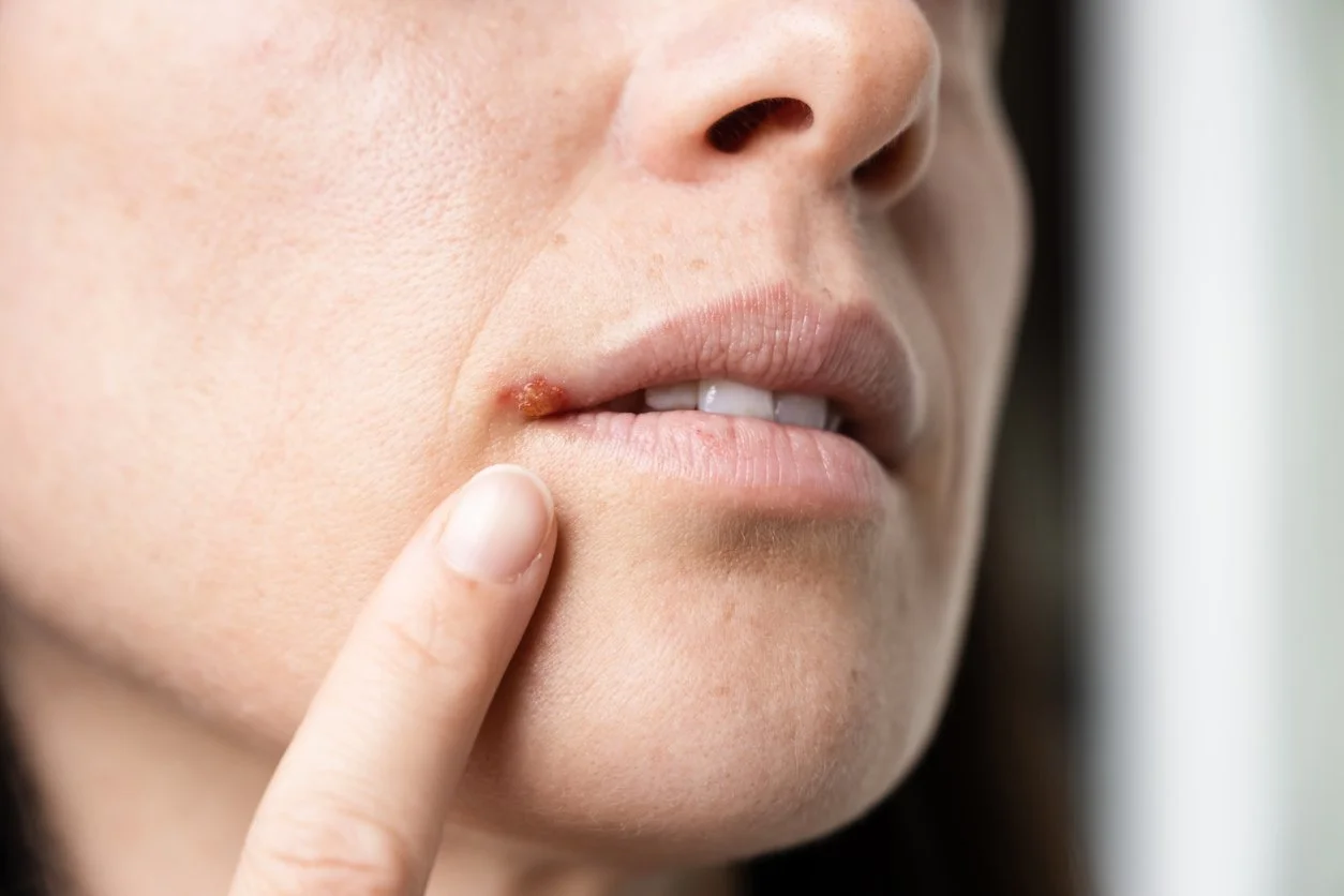 Understanding Cold Sores: Triggers, Symptoms, and Proven Treatment ...