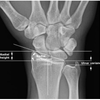 Distal Radius Fractures and Splinting — Kwak Talk