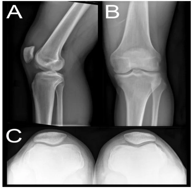 Patella Fracture — Kwak Talk